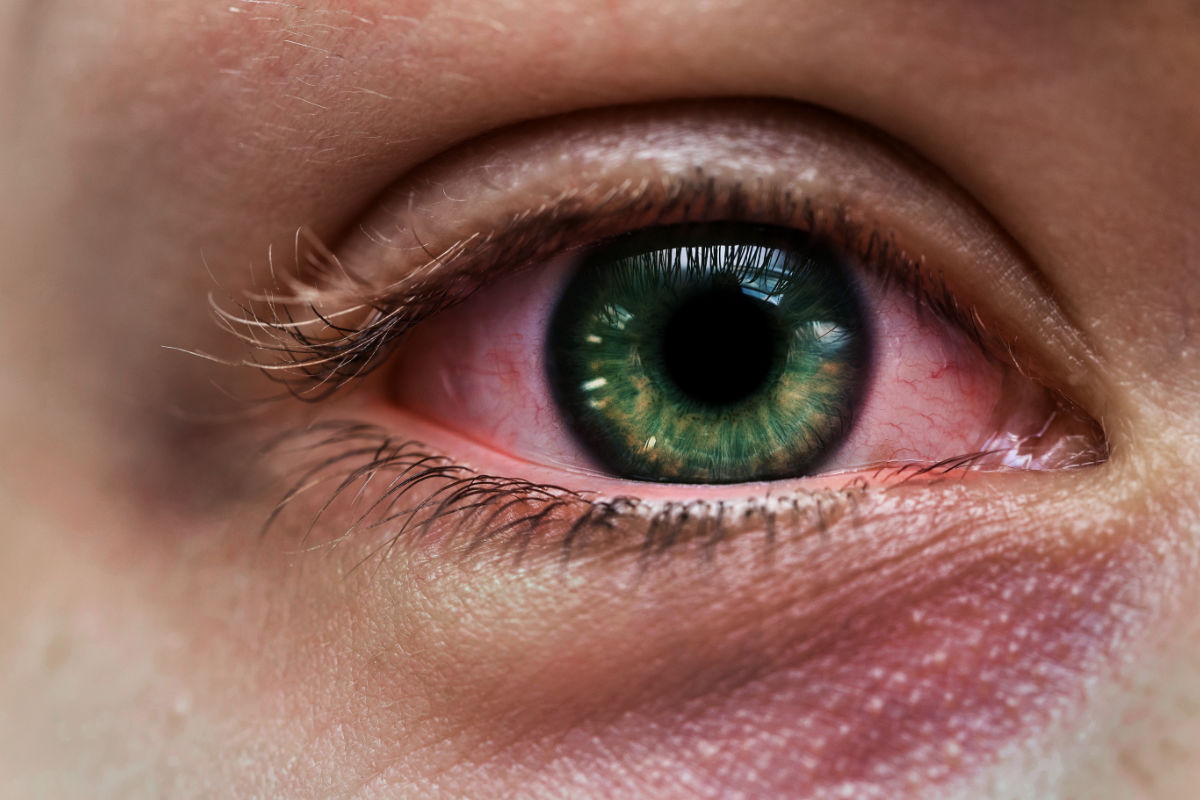 Viral Conjunctivitis - Vision and Eye Health